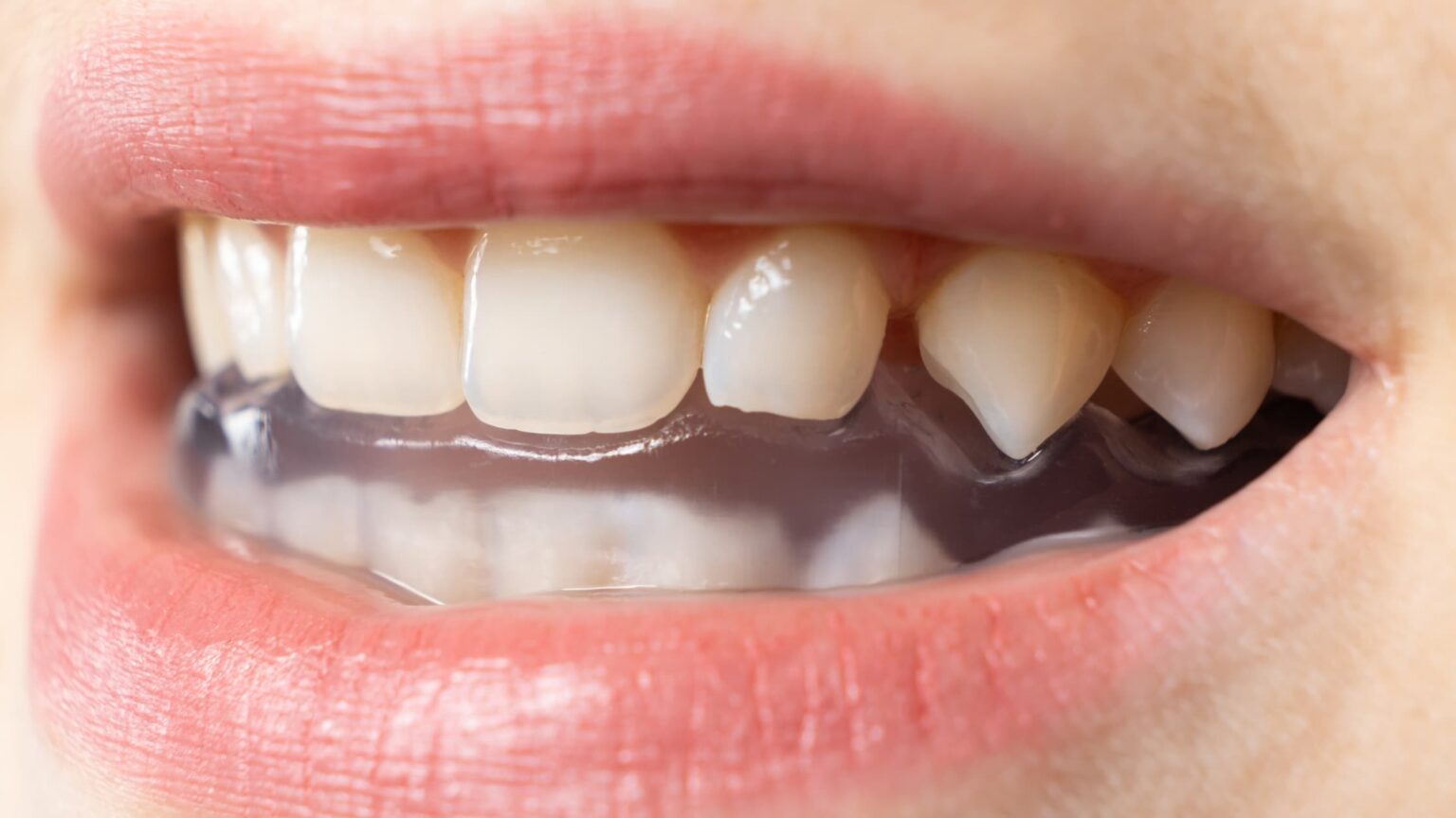 ¿Qué son los dientes de leche y por qué son importantes? - Clínica ...